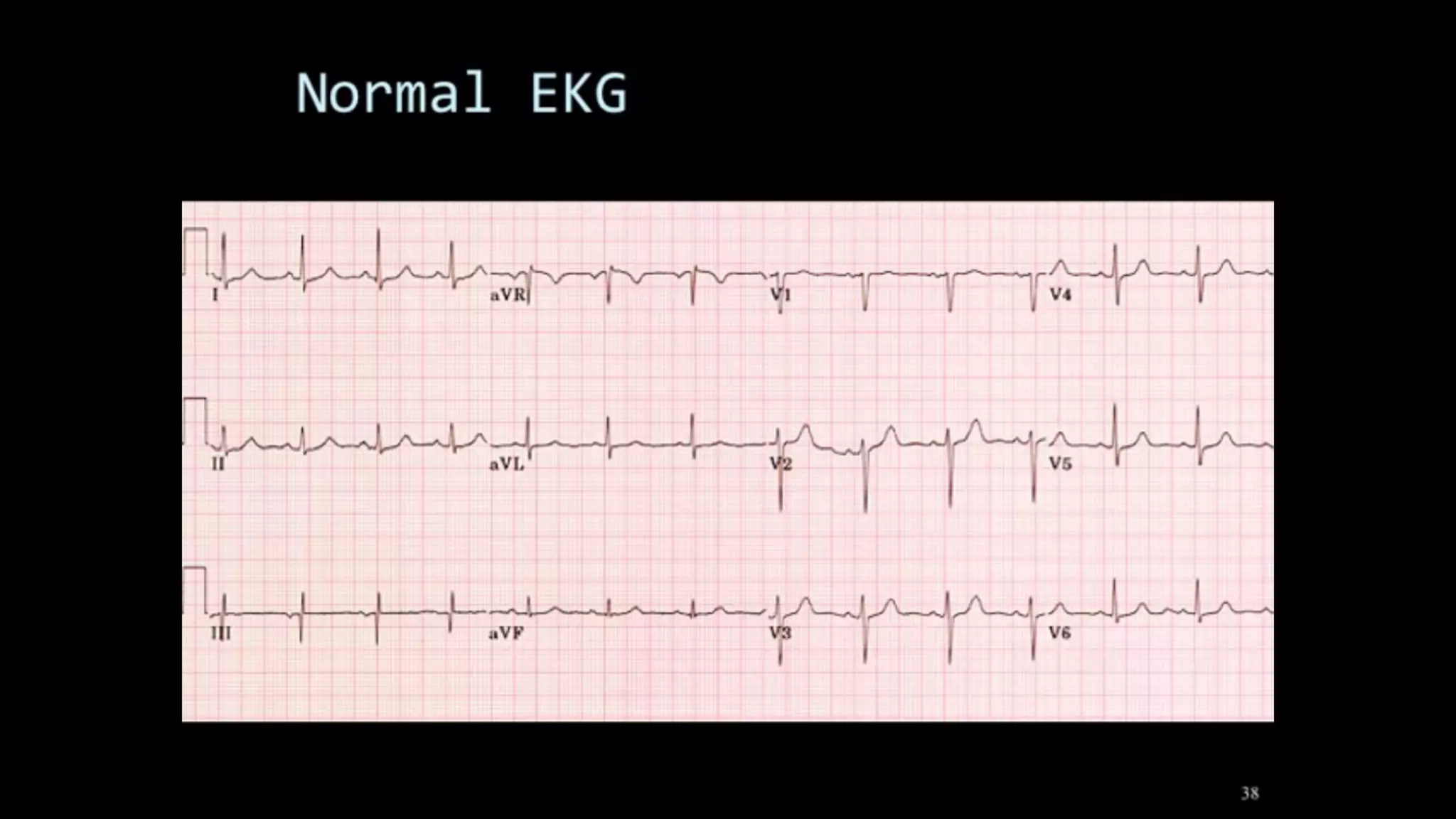 REVISI Materi 1 ECG Club - Dasar EKG, Sinus, Rate.pptx