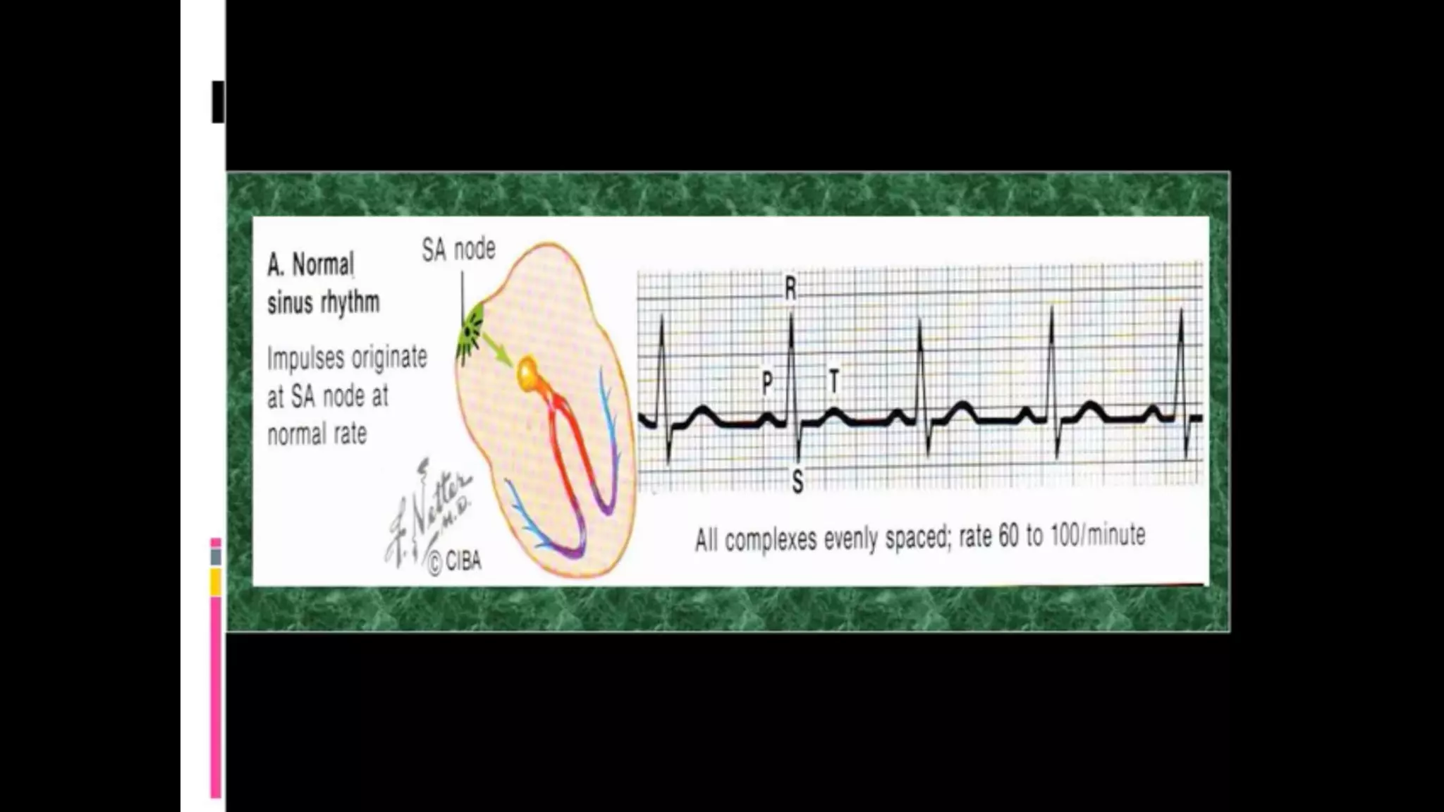 REVISI Materi 1 ECG Club - Dasar EKG, Sinus, Rate.pptx