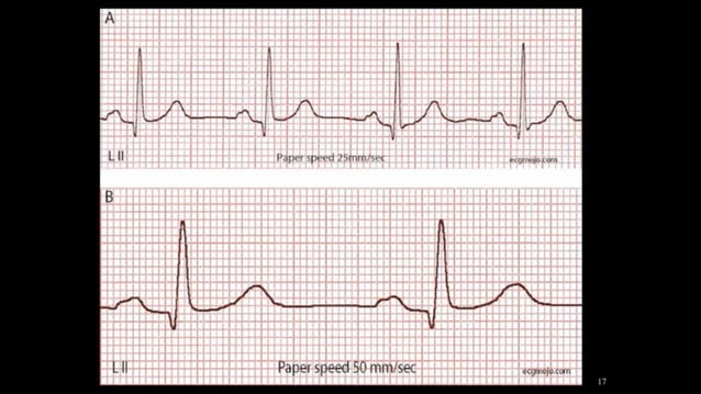 REVISI Materi 1 ECG Club - Dasar EKG, Sinus, Rate.pptx