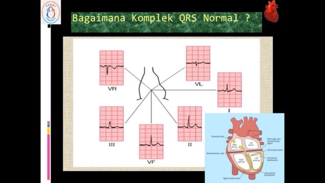 REVISI Materi 1 ECG Club - Dasar EKG, Sinus, Rate.pptx