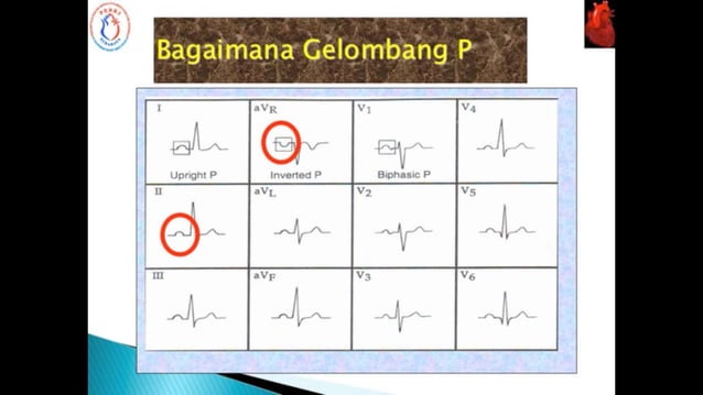 REVISI Materi 1 ECG Club - Dasar EKG, Sinus, Rate.pptx