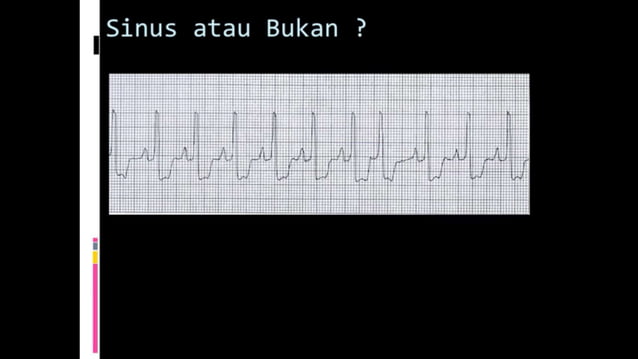 REVISI Materi 1 ECG Club - Dasar EKG, Sinus, Rate.pptx