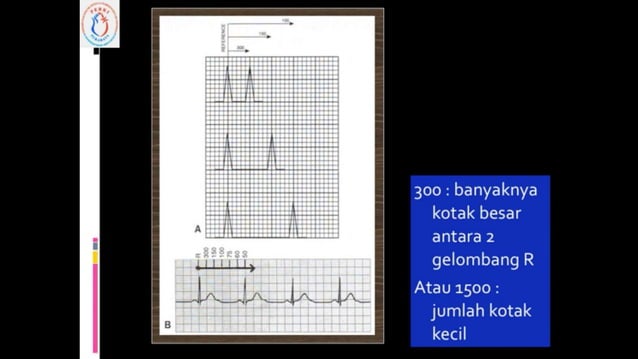REVISI Materi 1 ECG Club - Dasar EKG, Sinus, Rate.pptx