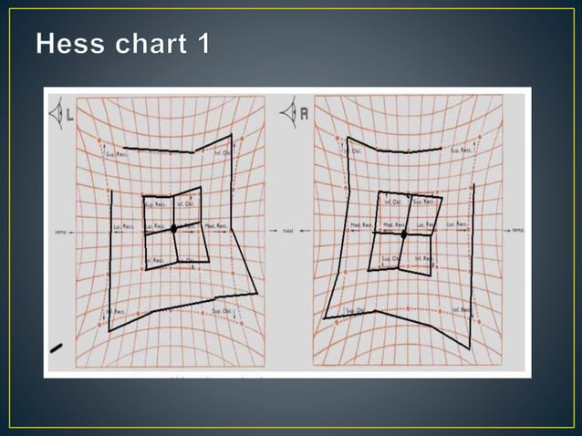 Revision about Hess Chart | PPTX | Eye and Vision Conditions | Diseases ...