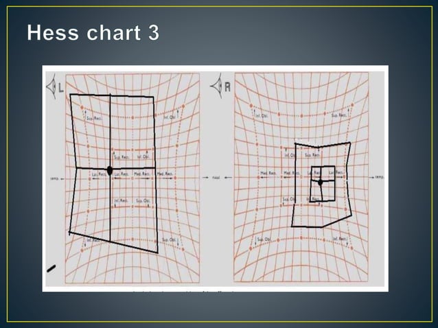 Revision about Hess Chart | PPTX | Eye and Vision Conditions | Diseases and Conditions