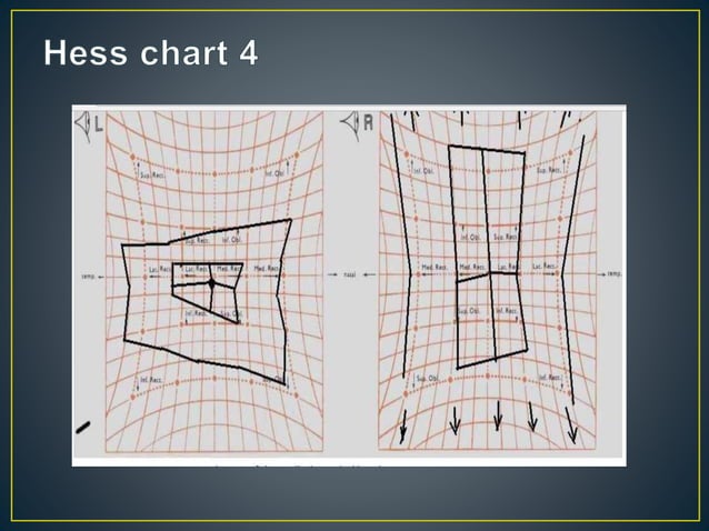 Revision about Hess Chart | PPTX | Eye and Vision Conditions | Diseases and Conditions