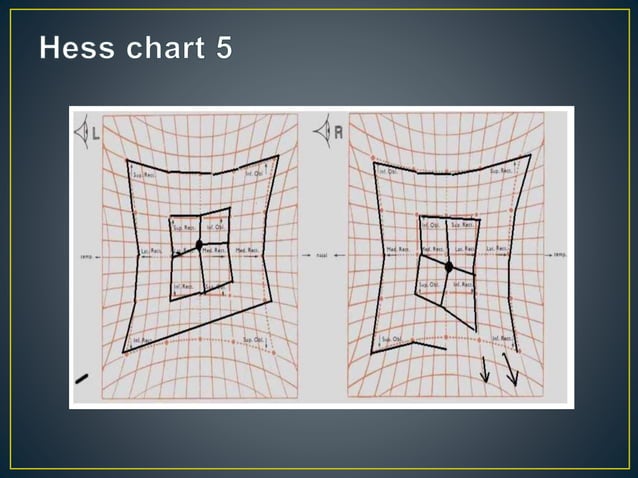 Revision about Hess Chart | PPTX | Eye and Vision Conditions | Diseases and Conditions