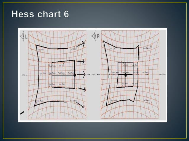 Revision about Hess Chart | PPTX | Eye and Vision Conditions | Diseases and Conditions