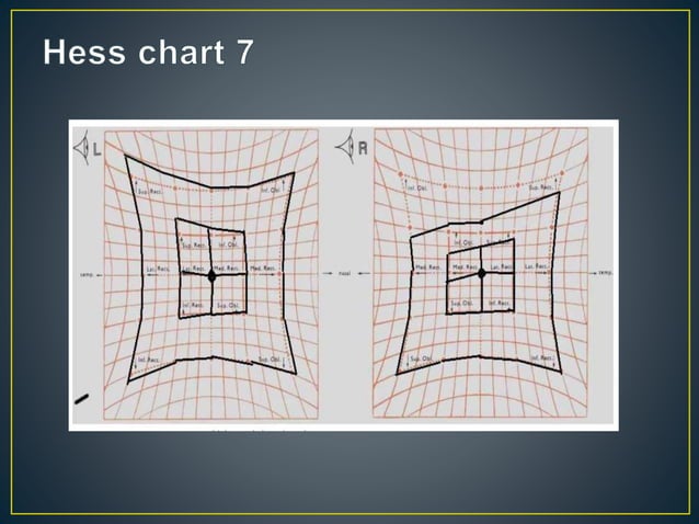 Revision about Hess Chart | PPTX | Eye and Vision Conditions | Diseases ...