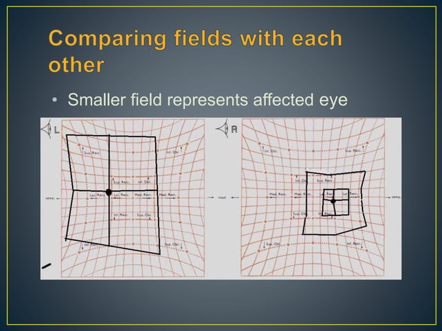Revision about Hess Chart | PPTX | Eye and Vision Conditions | Diseases ...