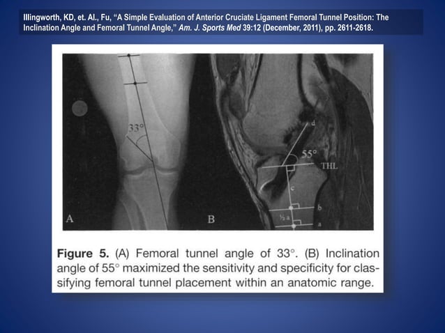 Revision ACL Reconstruction - A Case Presentation and Literature Review ...
