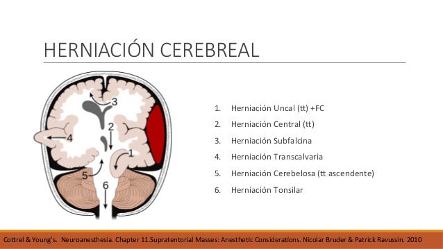 Revisión anestesia para tumores supratentoriales