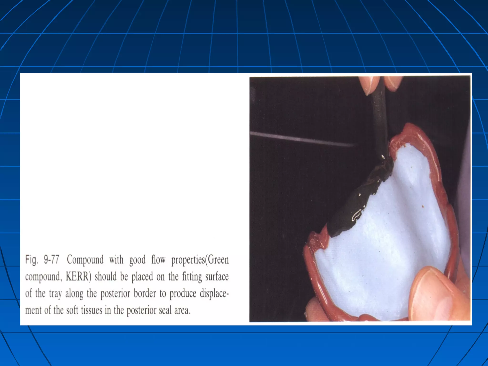 Revision clinical complete denture prosthodontics | PPT