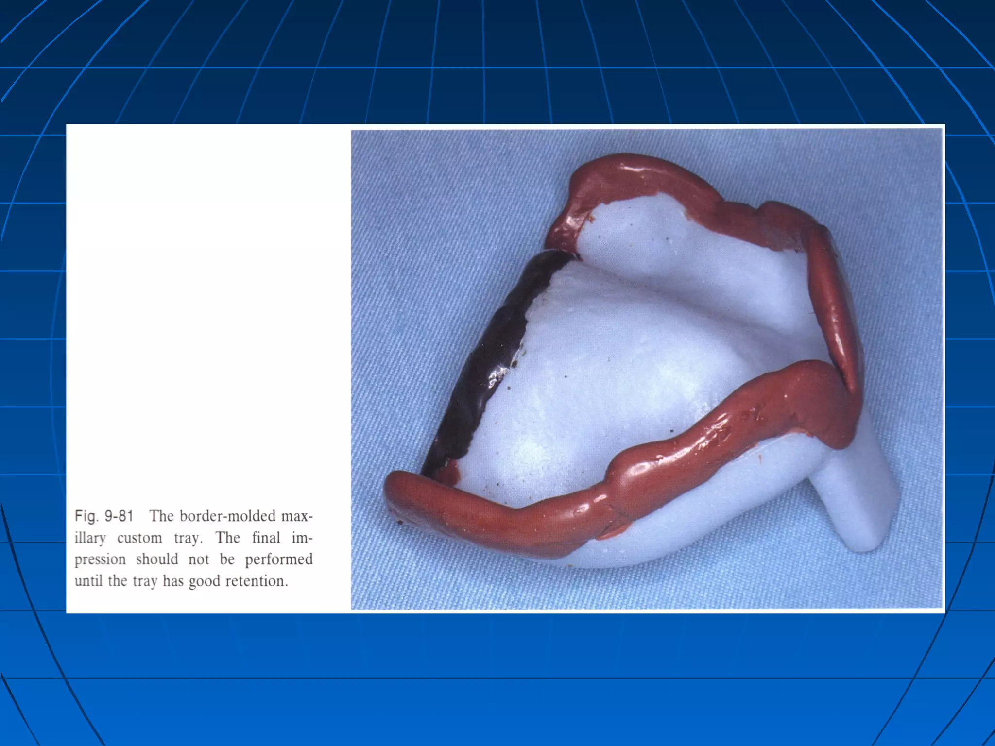 Revision clinical complete denture prosthodontics | PPT