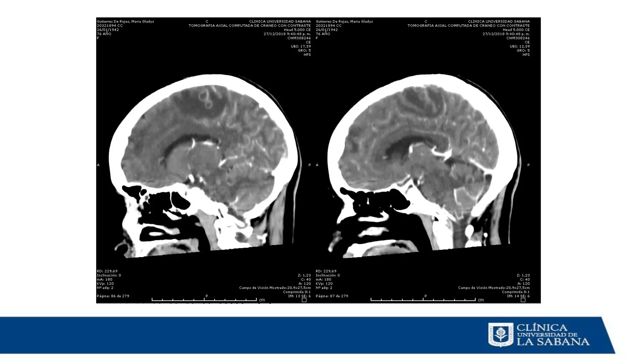 Revision Farmacología Clínica de la Neurocisticercosis | PDF | Brain ...