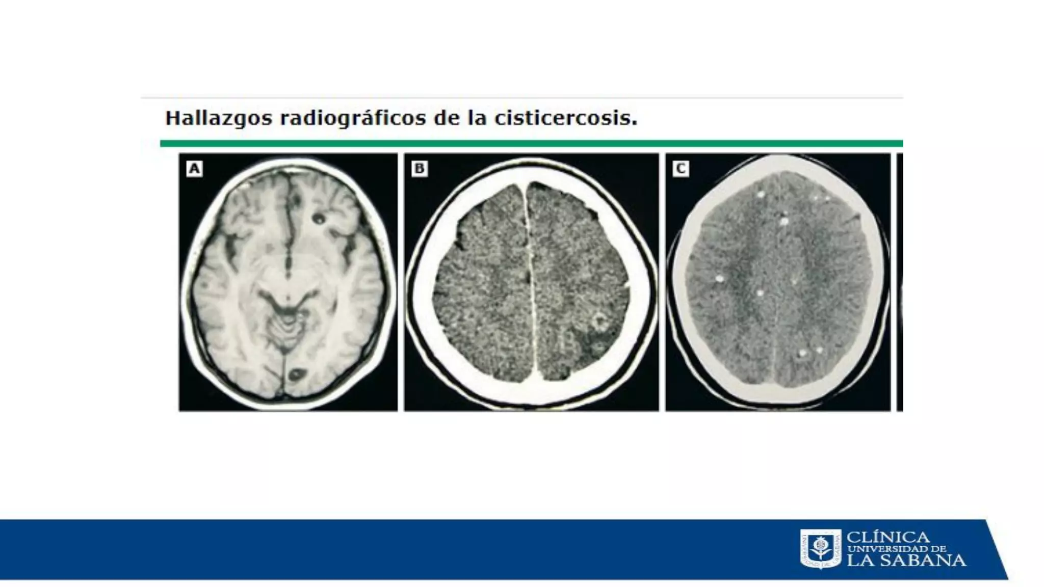 Revision Farmacología Clínica de la Neurocisticercosis | PDF | Brain ...