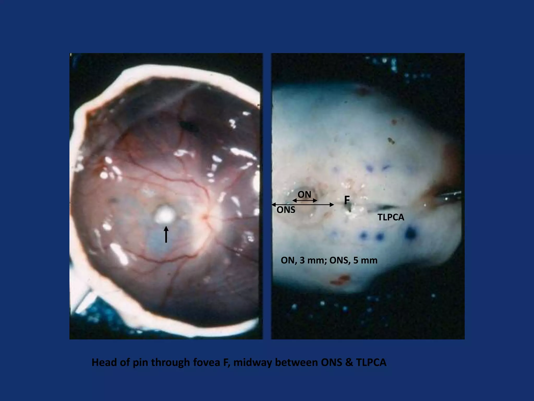Revision of the Anatomy of the Posterior Aspect of the Eyeball - An ...