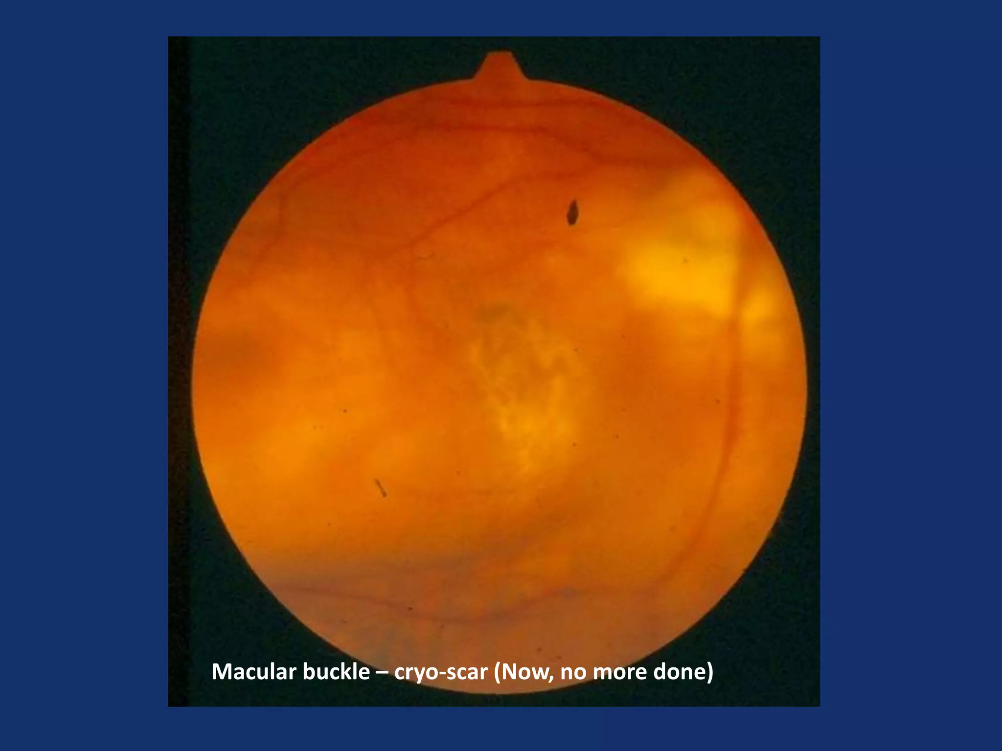 Revision of the Anatomy of the Posterior Aspect of the Eyeball - An ...