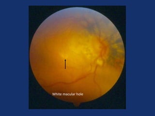 Revision of the Anatomy of the Posterior Aspect of the Eyeball - An ...