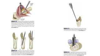 Revision Total Hip Replacement (THR): Surgical Principles, Techniques ...