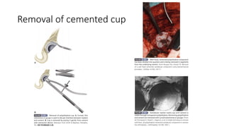 Revision Total Hip Replacement (THR): Surgical Principles, Techniques ...
