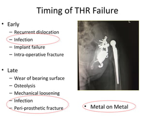 Revision thr indication, investigation & preparation | PPT
