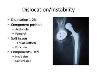 Revision thr indication, investigation & preparation | PPT