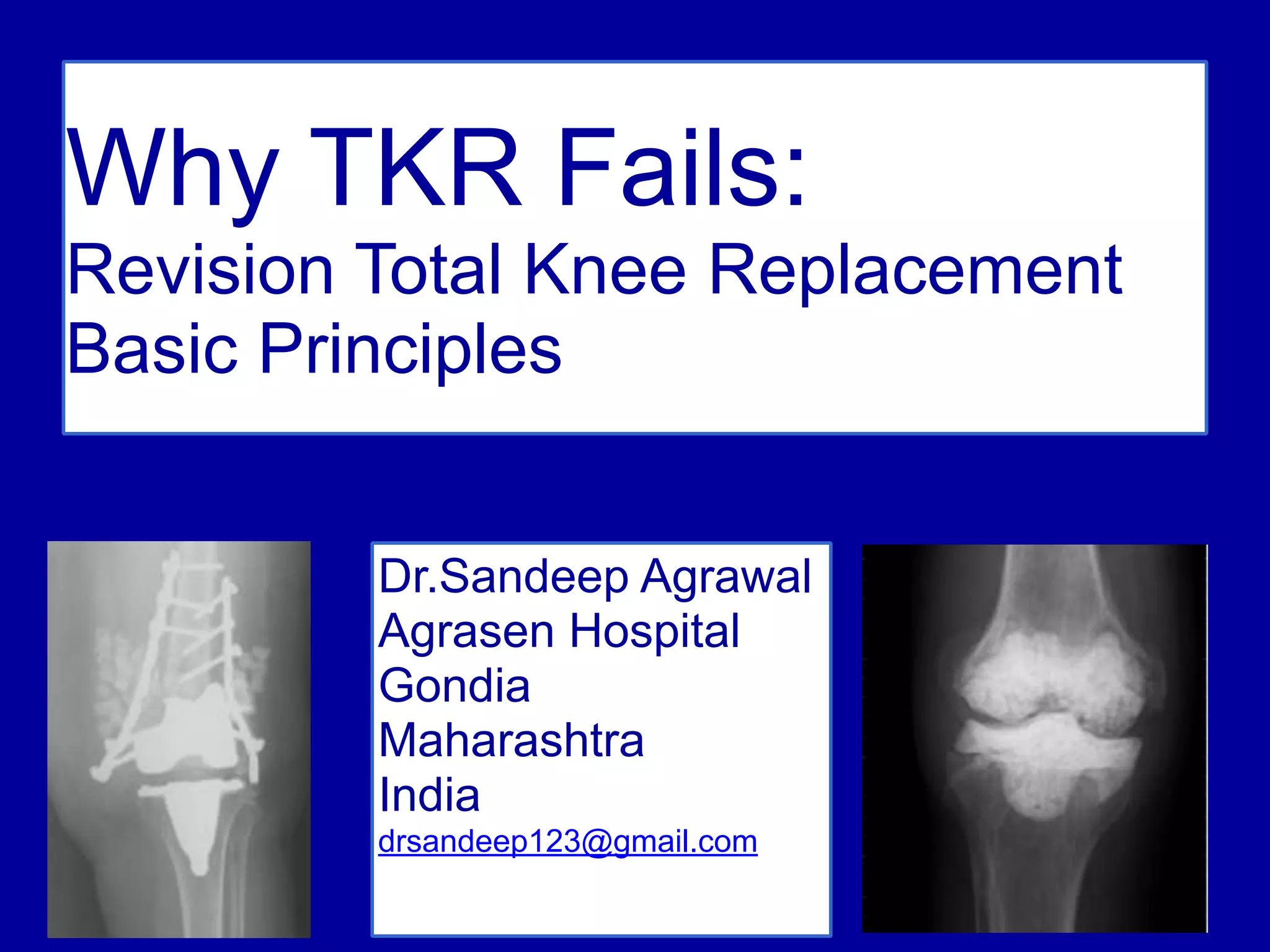 Revision TKR: Why Knee Fails Basic Surgical Principles Dr.Sandeep ...