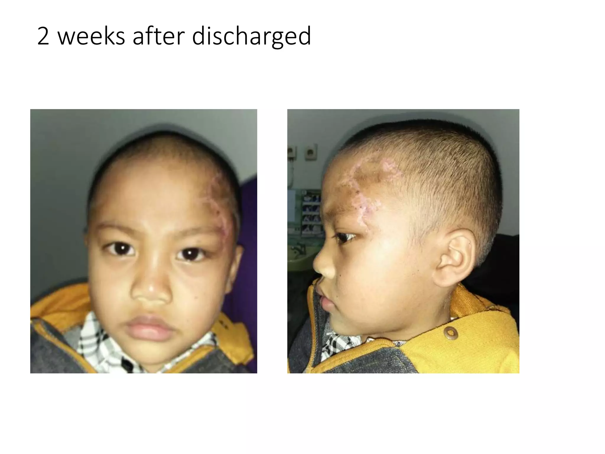 open skull fracture with open brain injury, Prolaps Cerebri | PPTX