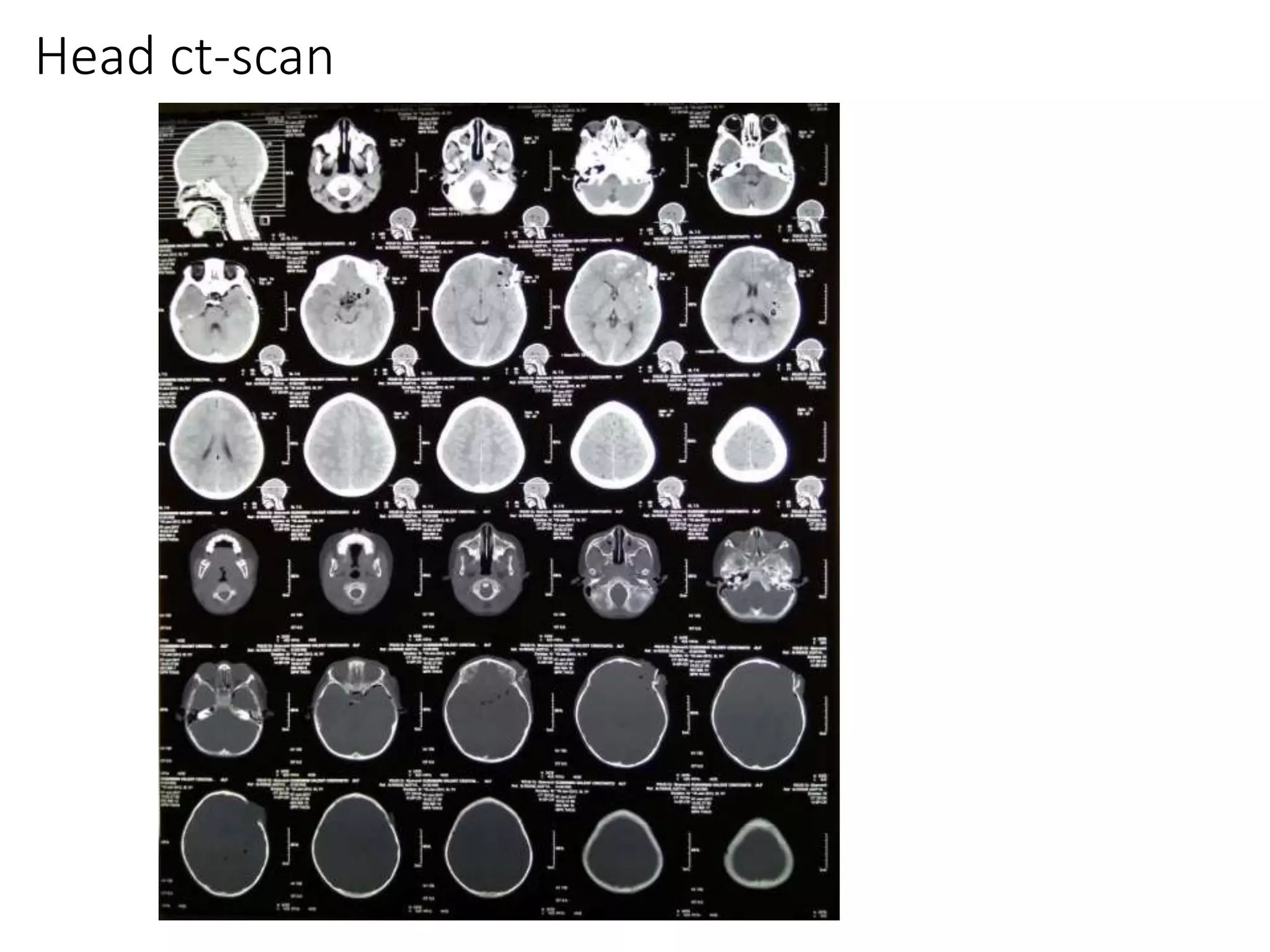 open skull fracture with open brain injury, Prolaps Cerebri | PPTX