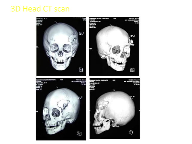 open skull fracture with open brain injury, Prolaps Cerebri | PPT