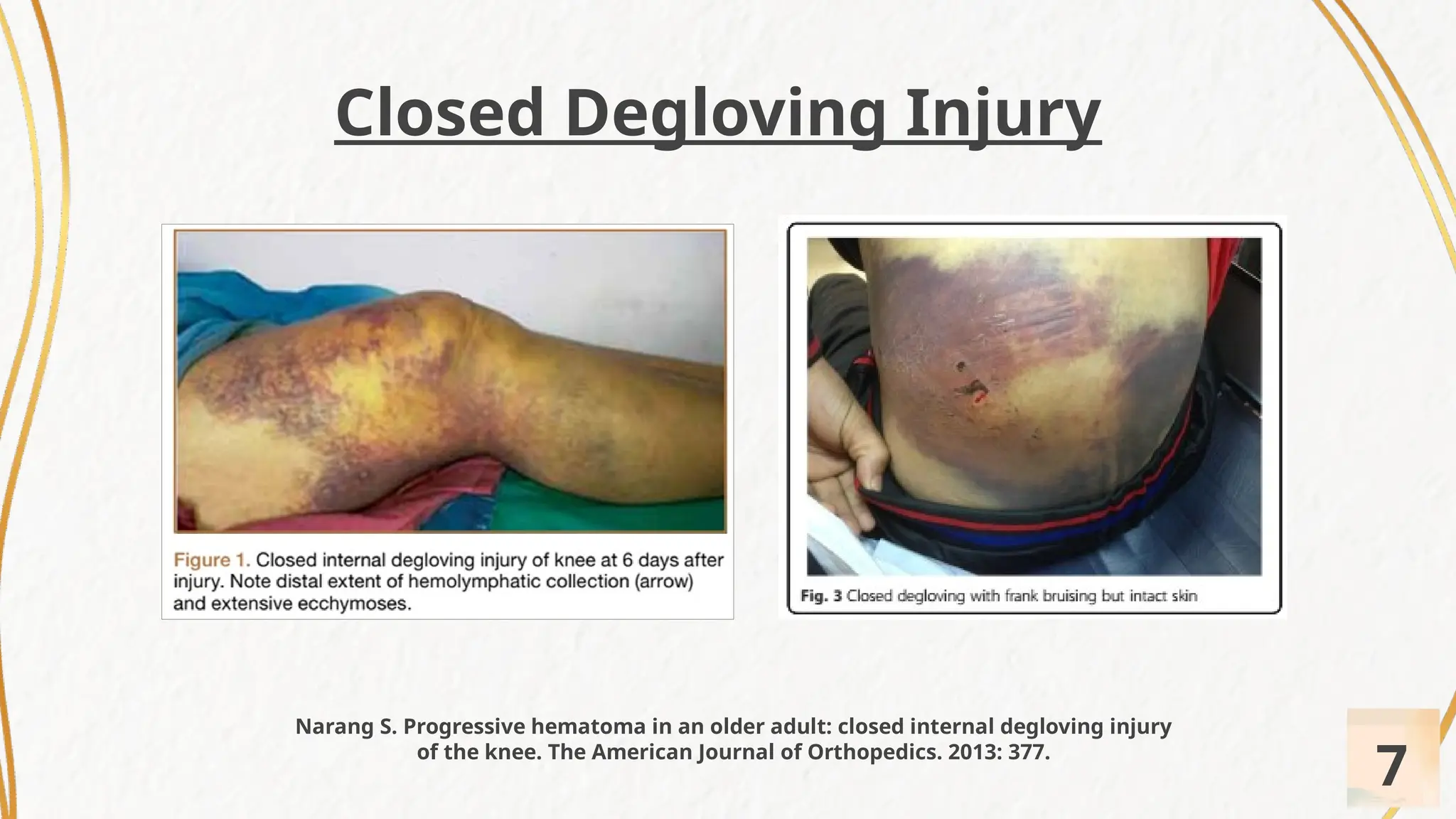 Revisi PPT Referat Open Degloving Injury.pptx