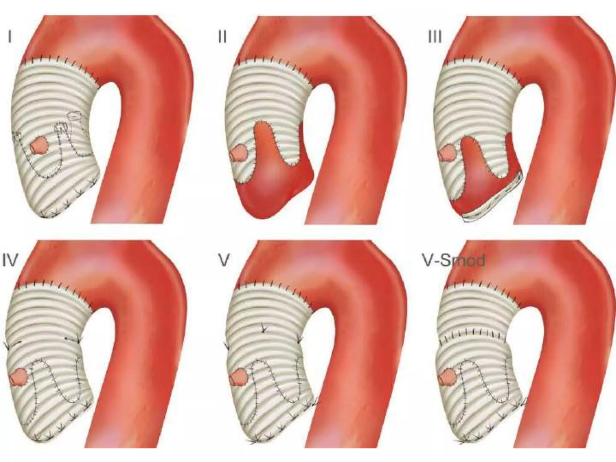 Revisiting bentall procedure | PPTX