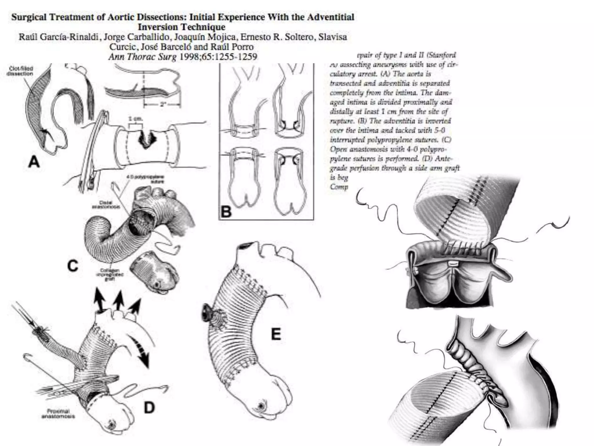 Revisiting bentall procedure | PPTX