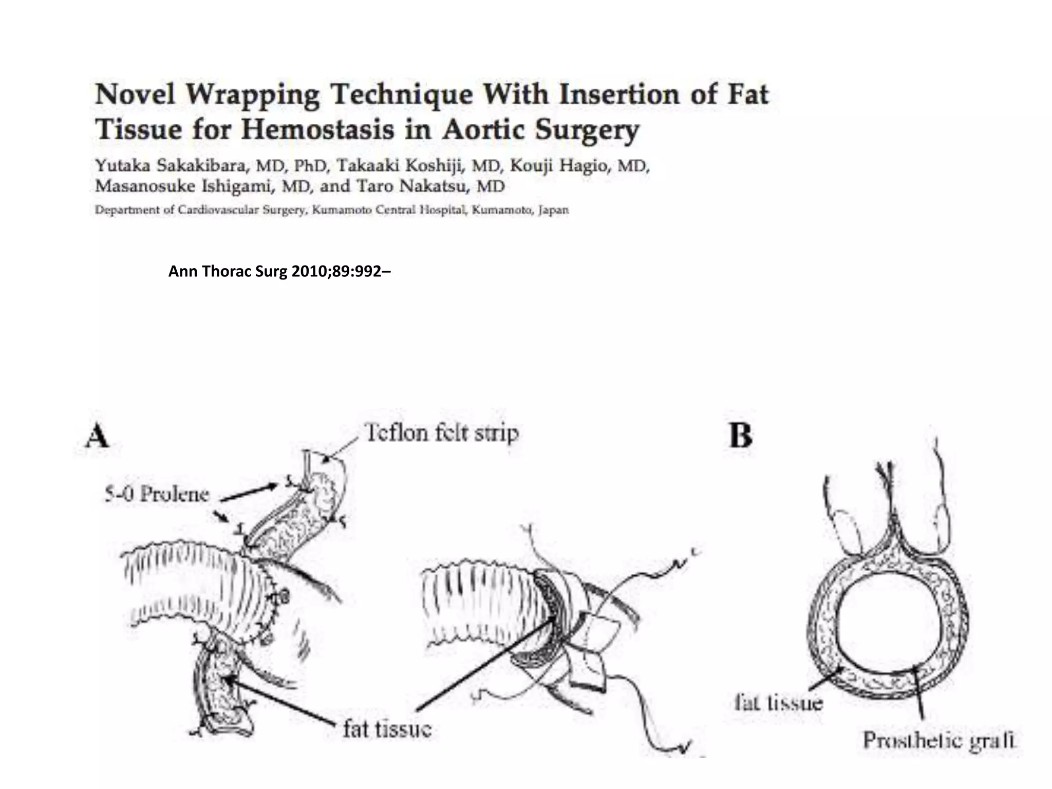 Revisiting bentall procedure | PPTX | First Aid | Injuries