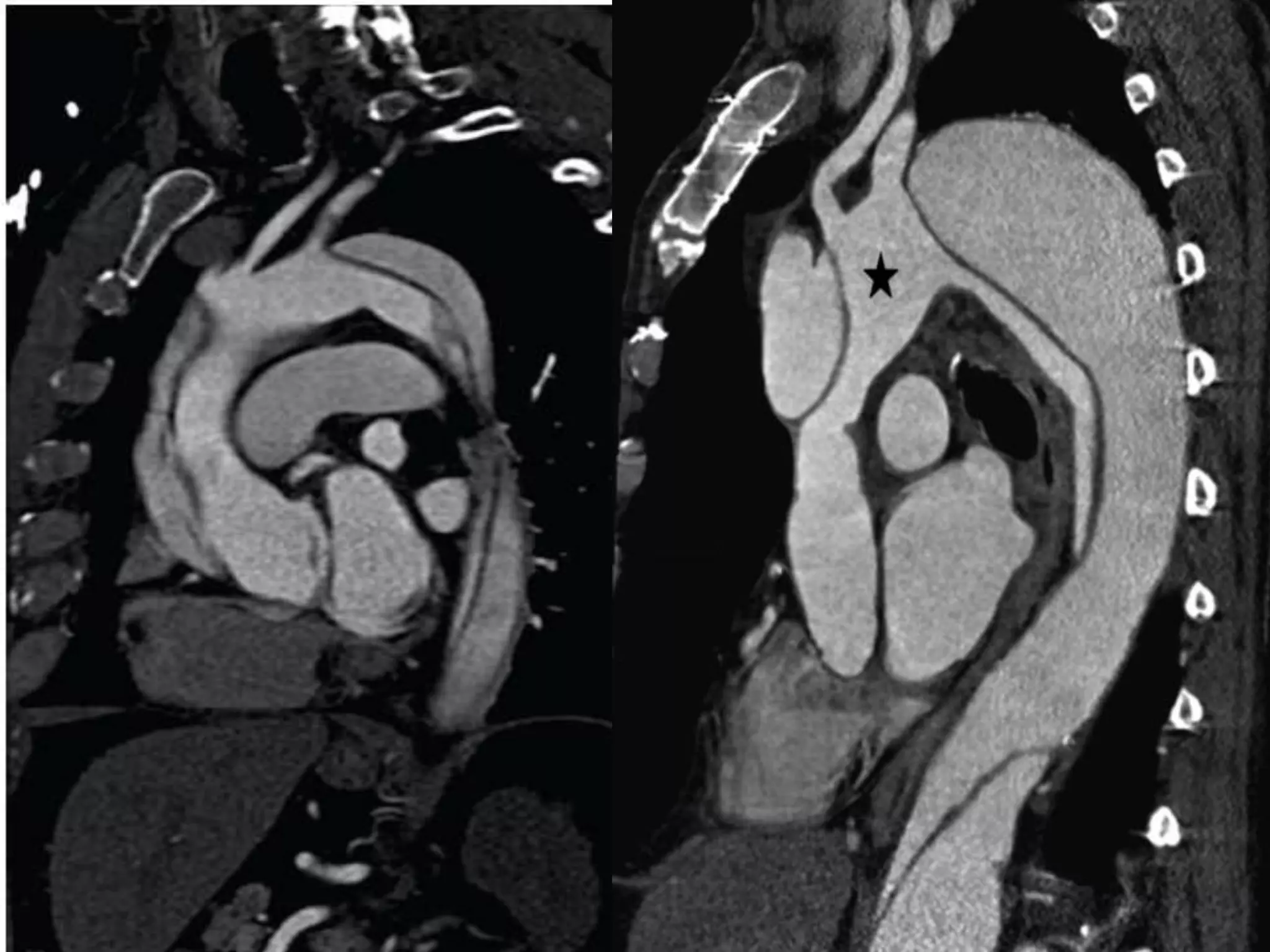 Revisiting bentall procedure | PPTX