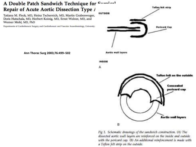 Revisiting bentall procedure | PPTX | First Aid | Injuries