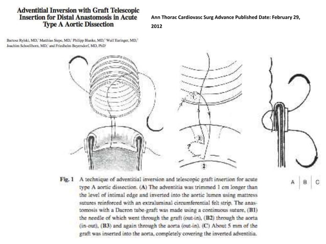 Revisiting bentall procedure | PPTX | First Aid | Injuries