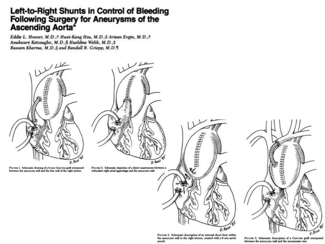Revisiting bentall procedure | PPTX | First Aid | Injuries