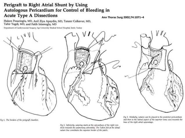 Revisiting bentall procedure | PPTX | First Aid | Injuries