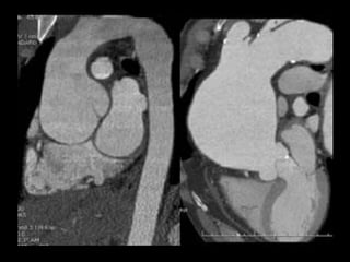 Revisiting bentall procedure | PPTX