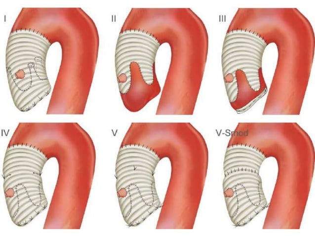 Revisiting bentall procedure