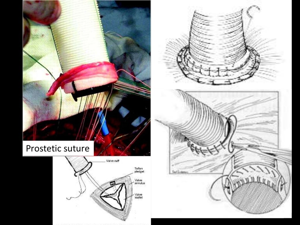 Revisiting bentall procedure