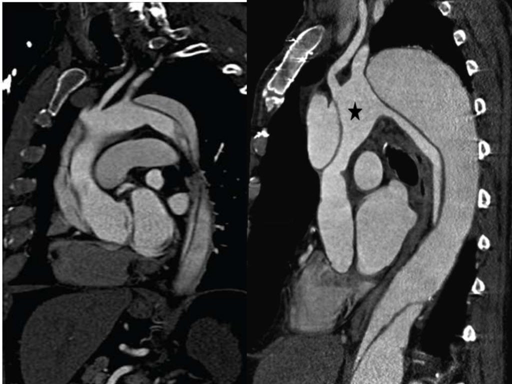 Revisiting bentall procedure