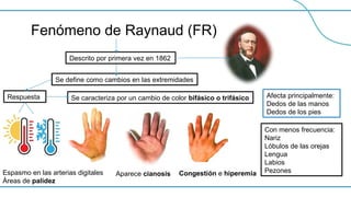 fenomeno de raynaud primario y secundario.pptx