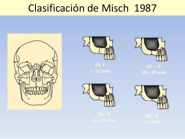 Revista de revistas. técnicas para manejo de seno maxilar. parte 2