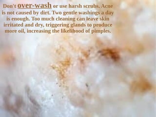 Teenage Acne Problems | ODP