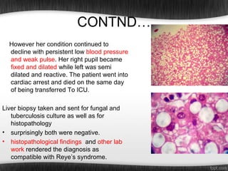 Reye's syndrome | PPT