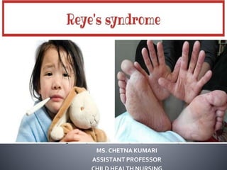 REYES SYNDROME.pptx