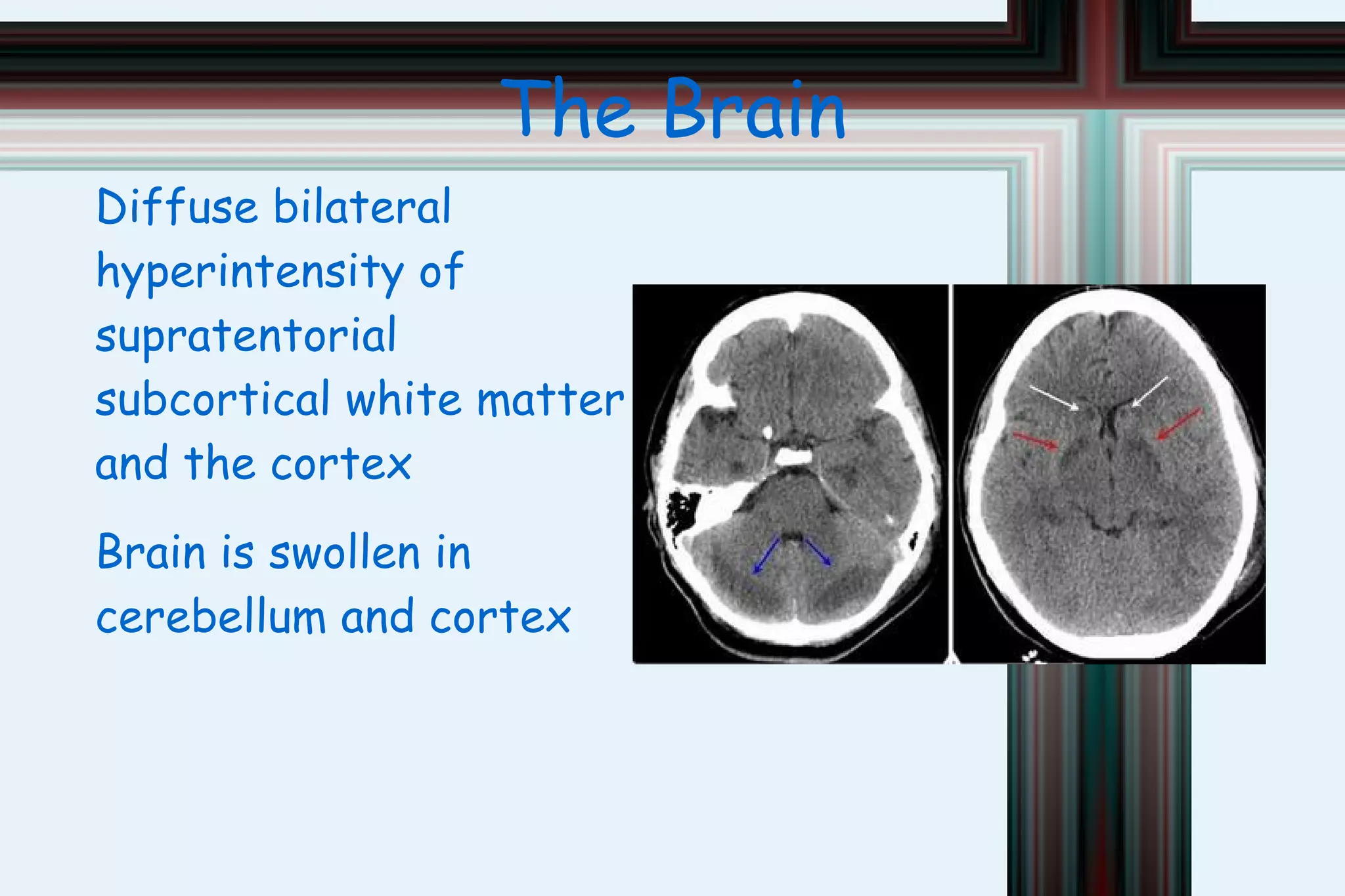 Reye's syndrome presentation | ODP